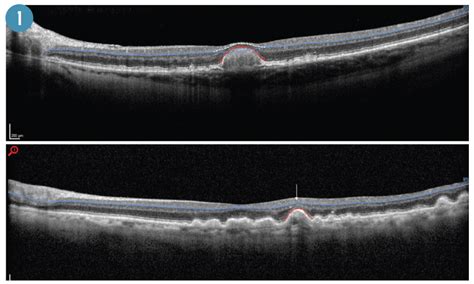 Effect Of Drusen And Atrophy On Automated Segmentation In Oct Images