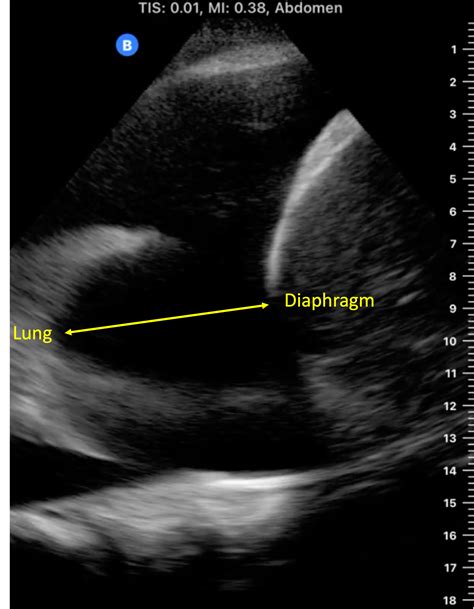 Pleural Effusion Ultrasound
