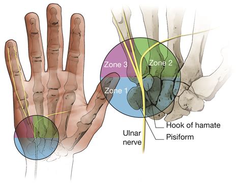 Ulnar Nerve Entrapment Wrist Ulnar Tunnel Syndrome Of The Wrist