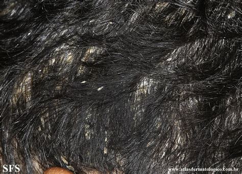 Pityriasis Amiantacea Nc Commons