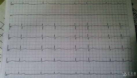 如何看房颤心电图 如何看房颤心电图