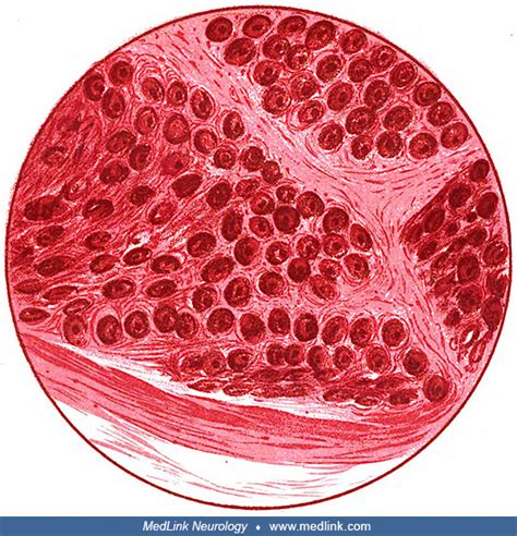 Transverse Section Of Posterior Interosseous Nerve From A Case Of Lead… Medlink Neurology