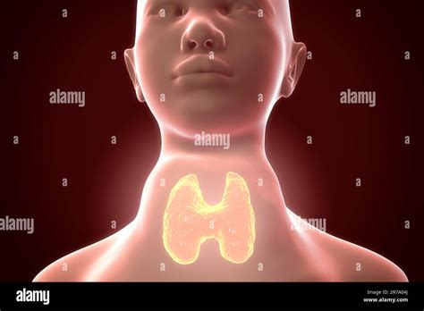 Toxic Diffuse Goiter Flajani Basedow Graves Disease 3d Illustration Showing Enlarged Thryoid