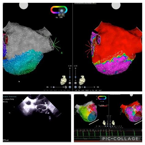 Video Ajit Janardhan On Linkedin Post Maze Atriclip And Biomvr And In Incessant Atypical Afl