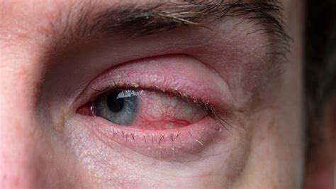 Eye Related Staph Infections