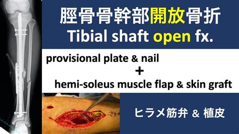 脛骨骨幹部開放骨折ORIFヒラメ筋弁植皮 ORIF soleus muscle flap skin graft for tibial