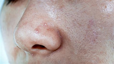 Sebum Plugs Causes Skin Health And Safe Removal