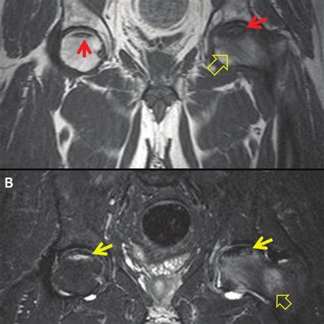 Pdf Mri Of The Hip Current Concepts On Bone Marrow Oedema