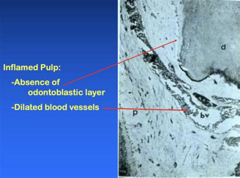 Pulp Inflammation Flashcards Quizlet