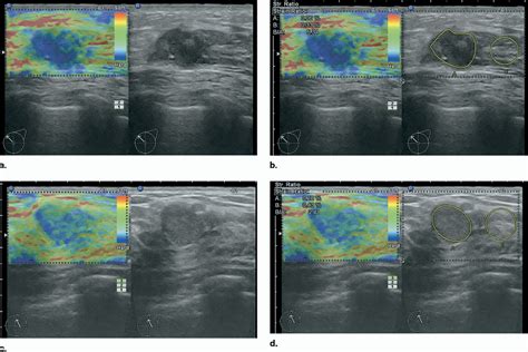 Figure 1 From Semi Quantitating Stiffness Of Breast Solid Lesions In Ultrasonic Elastography