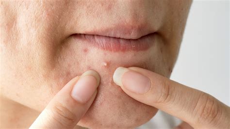 ¿qué Son Las Bolas De Grasa Que Aparecen En La Cara Y Cómo Quitarlas