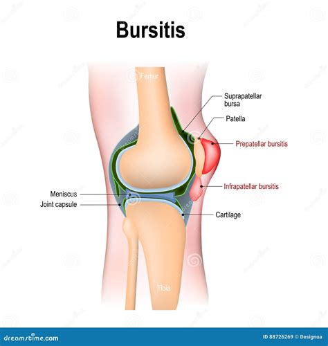 Prepatellar Bursitis Illustration Cartoon Vector