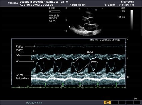 Parasternal Window Sonography Resources