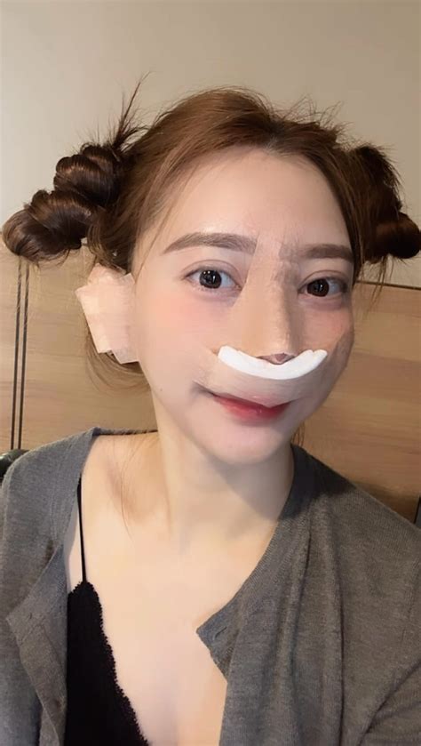 長直髮去手術一覺醒來就這髮型 沒猜錯是護理師綁的🤣🤣趁我麻醉的時候 回到飯店清醒才發現原來我是一路這樣回來