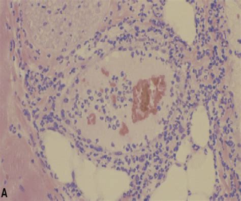 Lecture 30 Type Iii Hypersensitivity And Type Iv Hypersensitivity Flashcards Quizlet