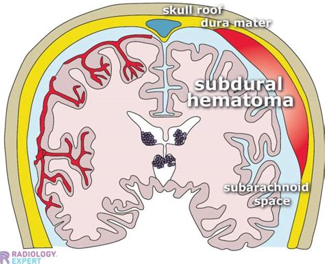Ct Brain Hemorrhage