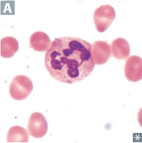 Megaloblastic Anemia Flashcards Quizlet