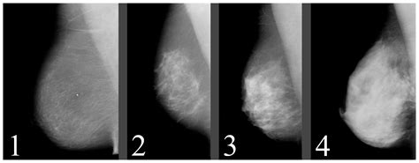 Mammography Datasets For Neural Networks—survey