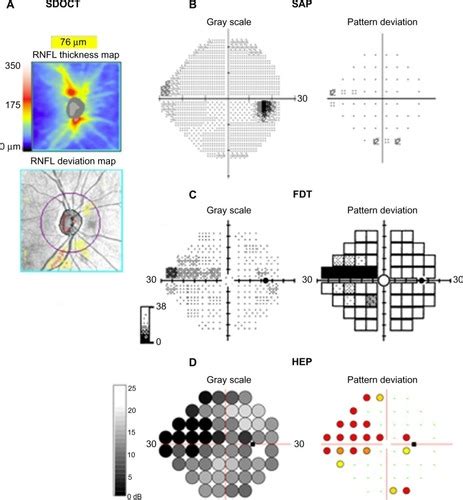 Full Article Strategies For Improving Early Detection Of Glaucoma The