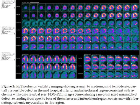 Hibernating Myocardium As A Cause Of Recurrent Ventricular Tachycardia Utility Of Fdg Pet