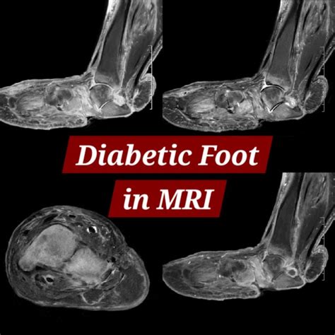 Mohamed Moustafa Abdelaal On Linkedin Diabetic Foot In Mri Mri Ankle