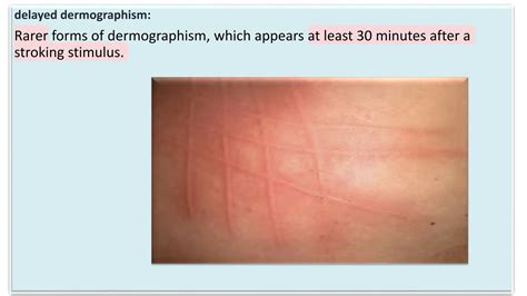 Urticaria Types And Management Bolognia Pptx