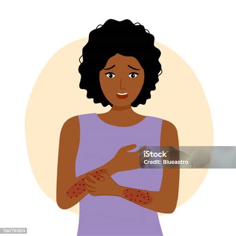 아프리카 여자 긁힘 팔 검은 여성은 평면 디자인에 강한 알레르기 피부 가려운 증상으로 고통 붉은 발진 피부 자극 습진에 대한 스톡 벡터 아트 및 기타 이미지 Istock