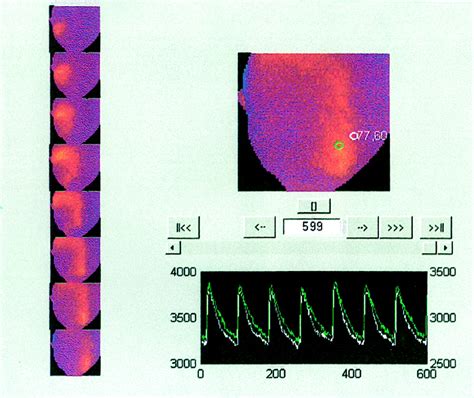 Spatial Heterogeneity Of Calcium Transient Alternans During The Early