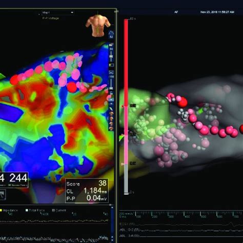Pdf Ensite™ Precision 3d Cardiac Mapping System