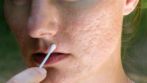 ¿se Pueden Eliminar Las Cicatrices De Acné En La Cara Serzen