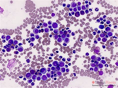 Cml In Chronic Phase Learnhaem Haematology Made Simple