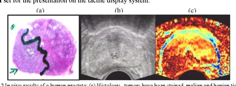Figure 1 From A Haptic Sensor Actor System Based On Ultrasound Elastography And
