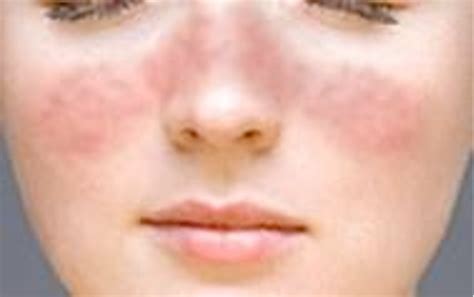 Exam 3 Rheumatic Disorders Flashcards Quizlet