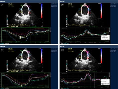 Myocarditis Echo Findings Myocarditis The Disease Is Commonly Caused By Viral