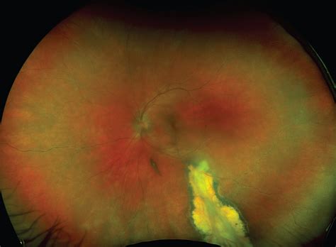 Posterior Uveitis