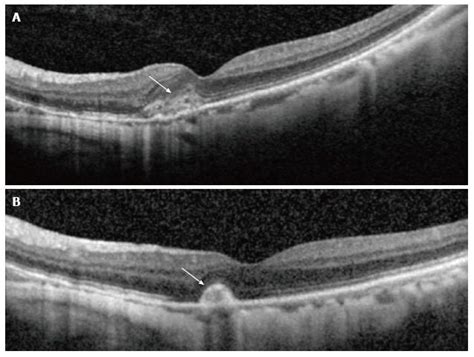 Choroidal Neovascularization Secondary To Pathological Myopia