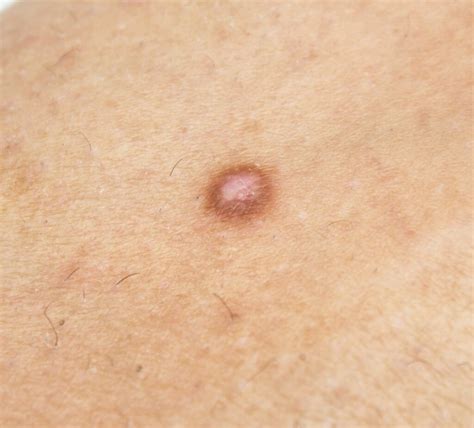 Granuloma Pyogenicum Ursachen Symptome And Behandlung