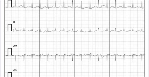 Ekg Album On Imgur