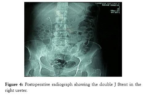 Bilateral Ureteral Duplication And Right Ectopic Ureter Presentin