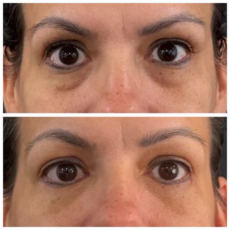 Dr Blefaroplastia Inferior Se Muestra El Postoperatorio De Una Blefaroplastia Inferior Se