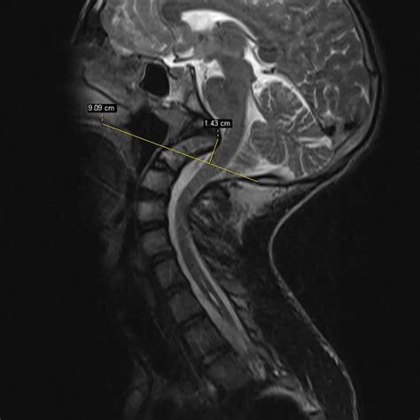 This Illustration Shows The Odontoid Process Of C2 Prolapsed Into The Download Scientific