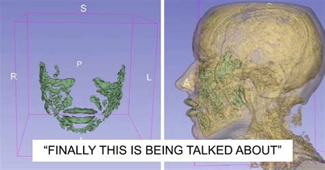 Mri Of 33 Year Old Womans Face Reveals Where All Her Filler Went Mri Of 33 Year Old Womans Face Reveals Where All Her Filler Went