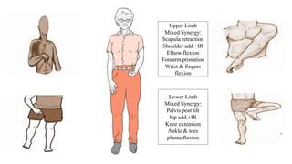 Flexor Synergy Spasticity And Stroke 53 Off