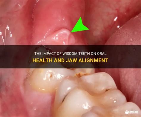 The Impact Of Wisdom Teeth On Oral Health And Jaw Alignment Medshun