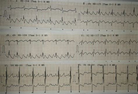 An Ecg Showed Atrial Flutter 90 X Minutes Incomplete Rbbb Rad And Rvh Download Scientific