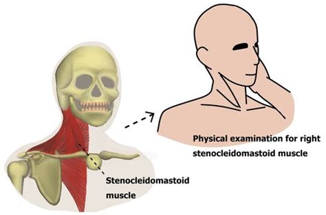 Sternocleidomastoid Action
