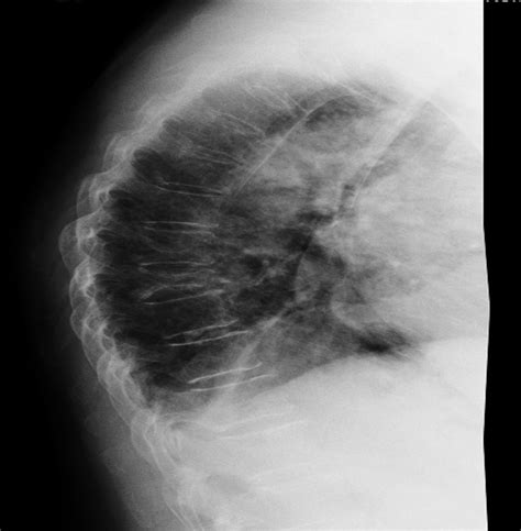 Bisphosphonates Beyond Five Years The Bmj
