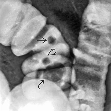 Colonic Polyps Radiology Key