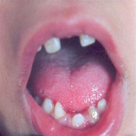 Diffuse Palmer Keratoderma With Arachnodactyly Of Hands And Feet Download Scientific Diagram