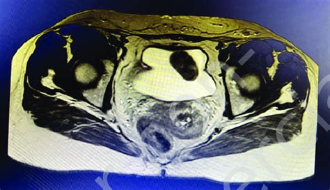 Case 2 Ct Scan Of The Bladder Mass Of The Anterior Wall Of The Bladder